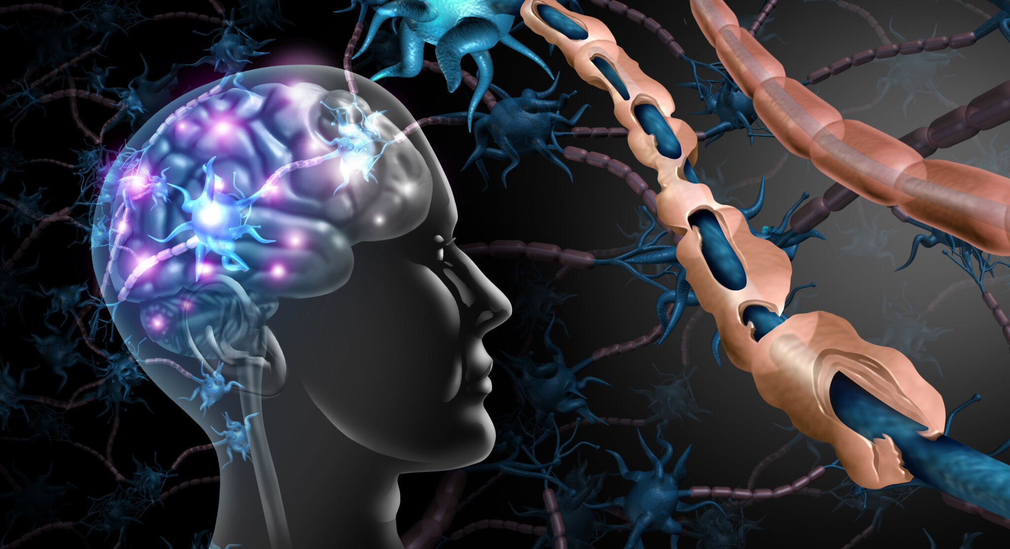 Esclerosis múltiple: qué es, síntomas y avances - Aiudo Blog