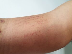 Las petequias en la piel: ¿Cómo actuar? - Aiudo Blog